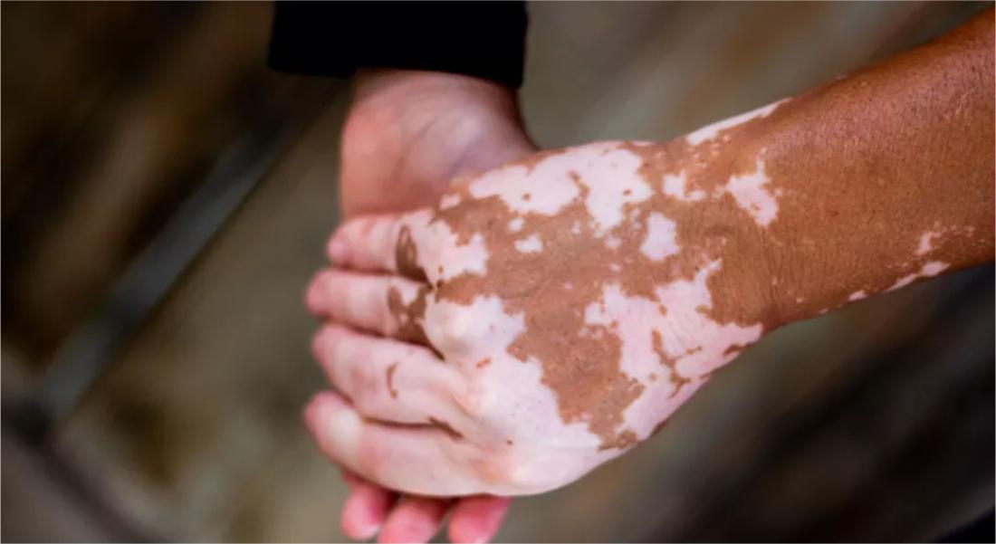 Conheça os tipos e as possíveis causas do vitiligo - Pró-Saúde